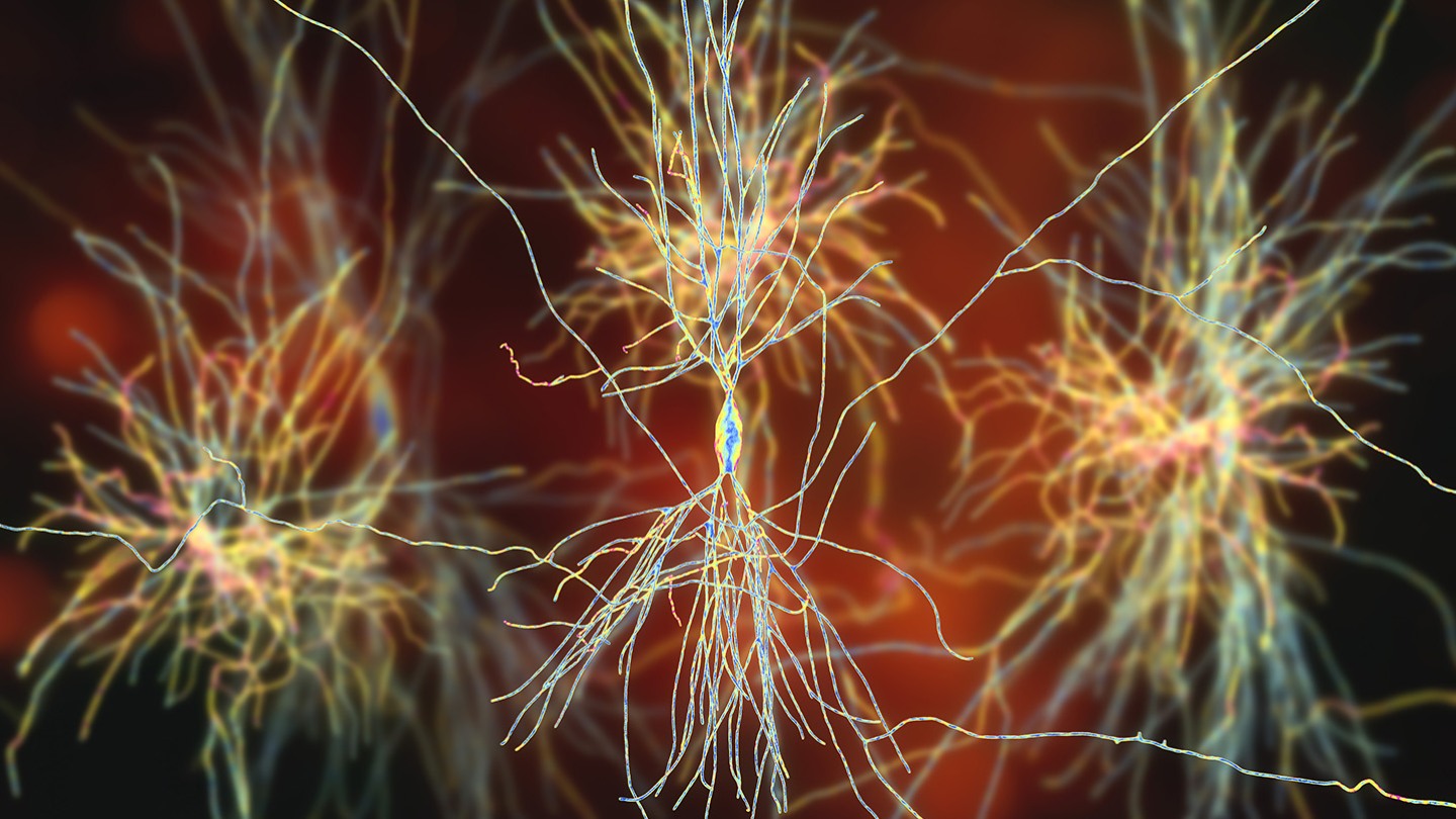 Center for Alzheimer's Disease Research | Carney Institute for Brain ...